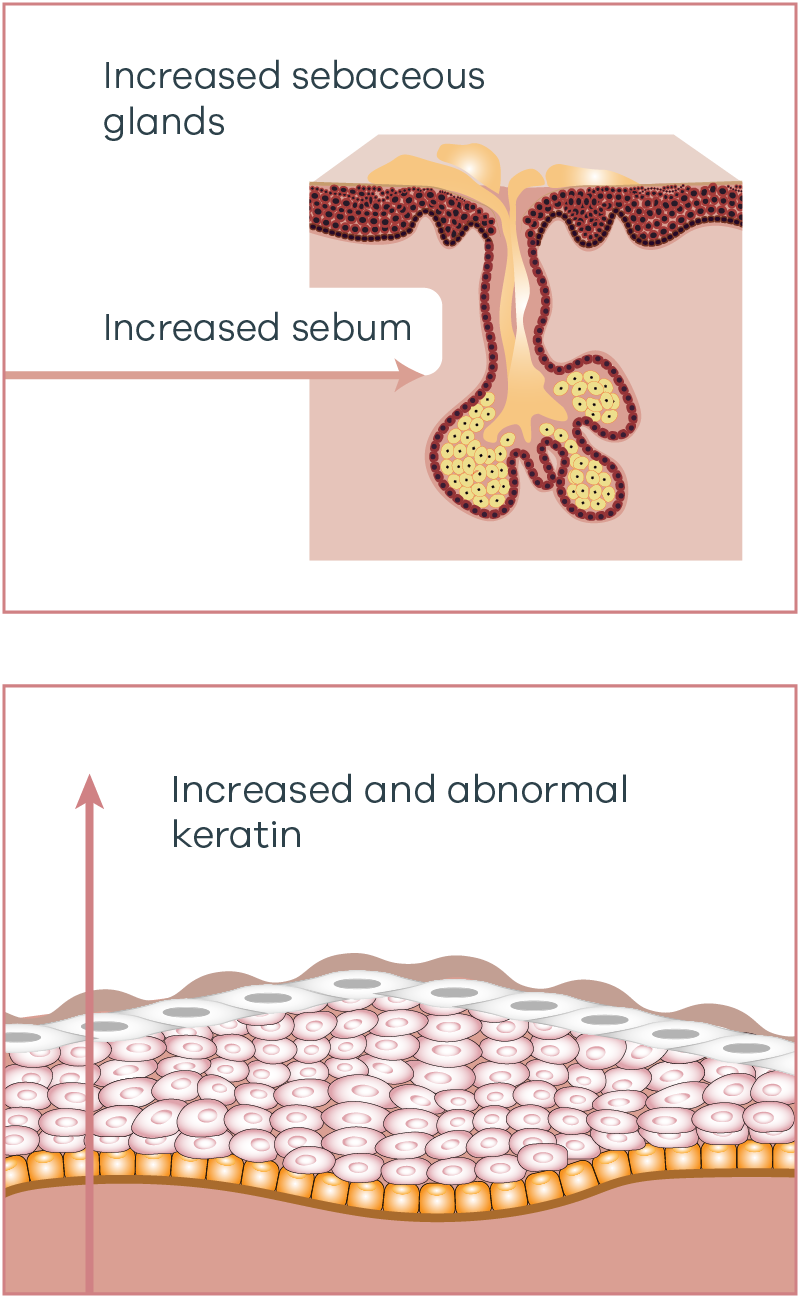 Acne: The Definitive Guide and Treatment - Anue