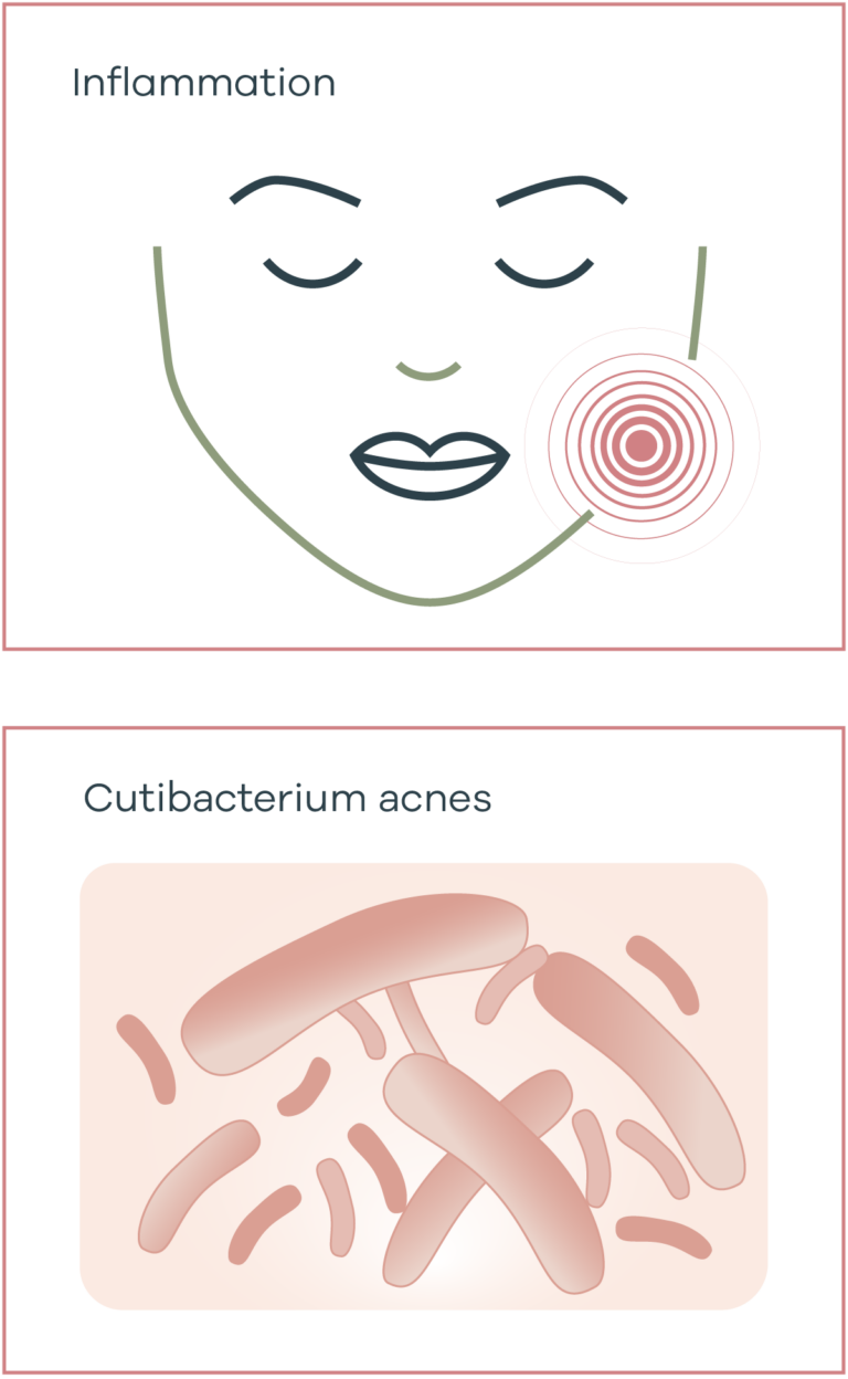 Acne: The Definitive Guide and Treatment - Anue