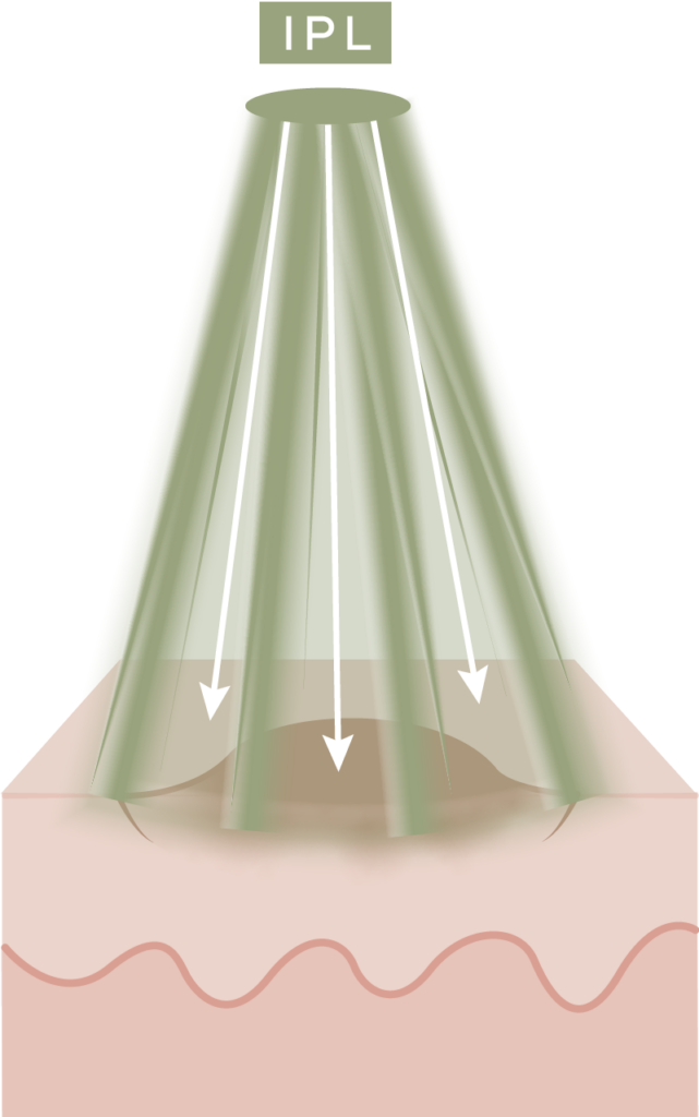 IPL: Intense Pulsed Light therapy at Anue