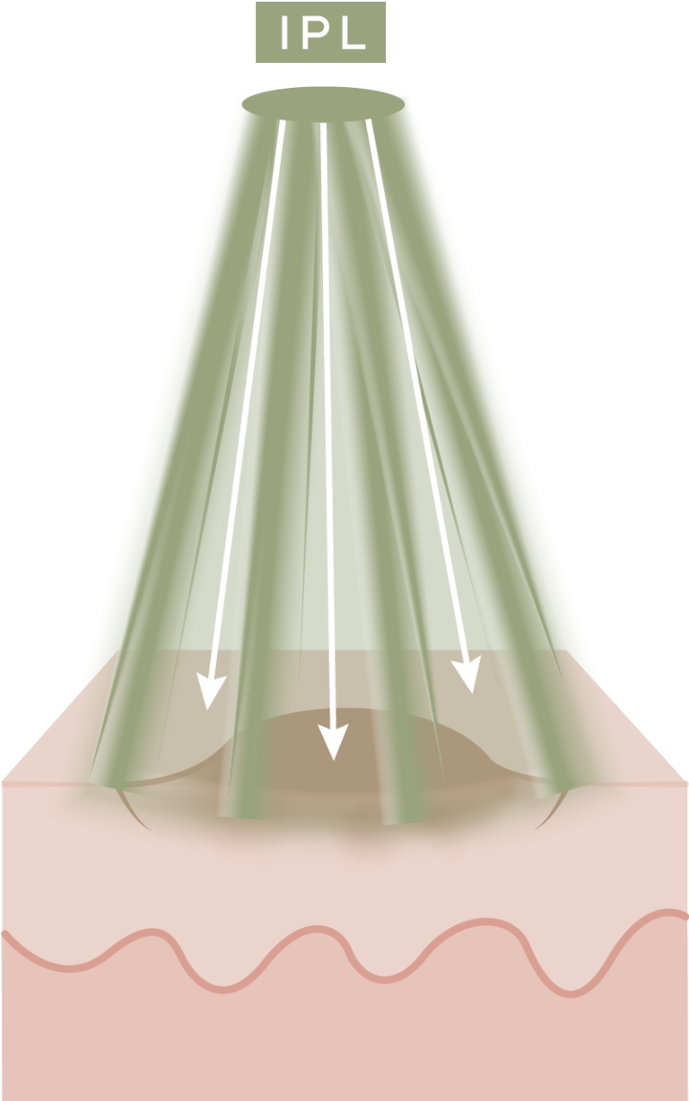 IPL: Intense Pulsed Light therapy at Anue