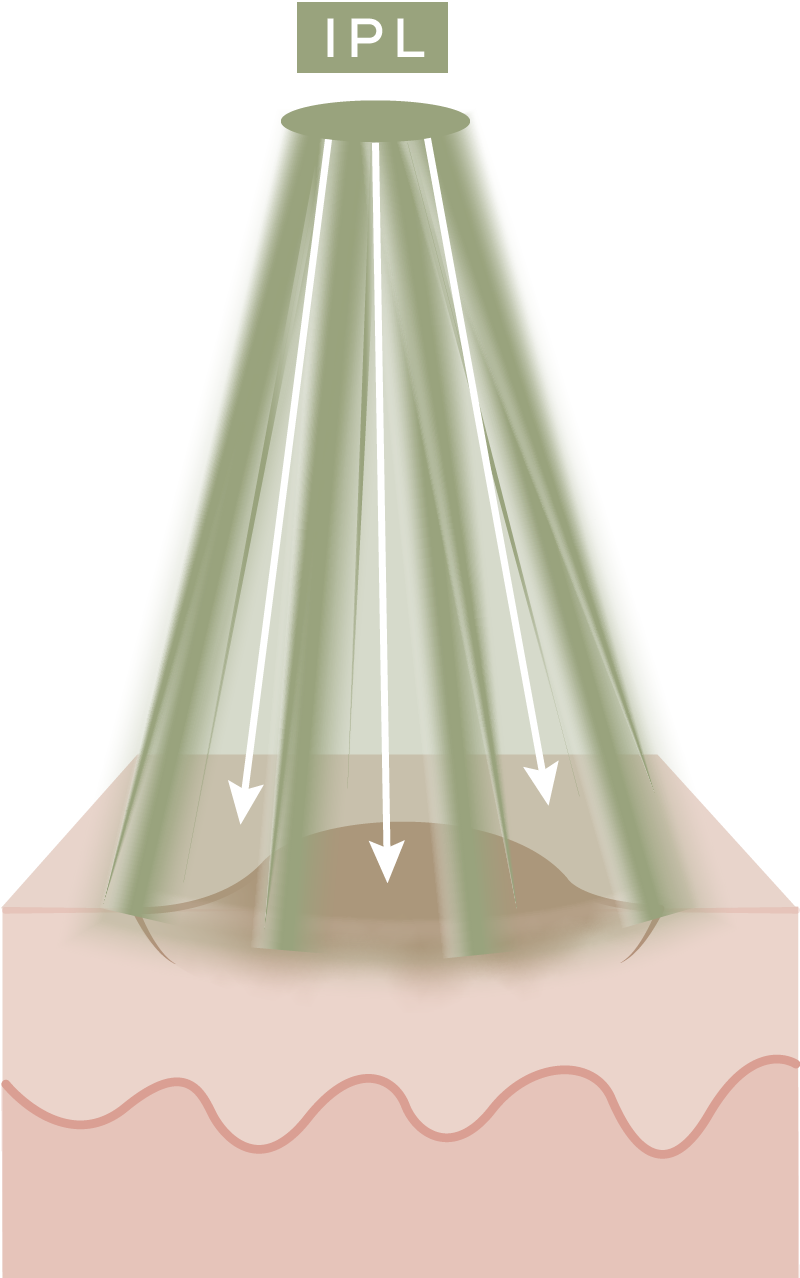 IPL: Intense Pulsed Light therapy at Anue