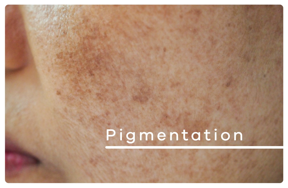 IPL: Intense Pulsed Light therapy at Anue