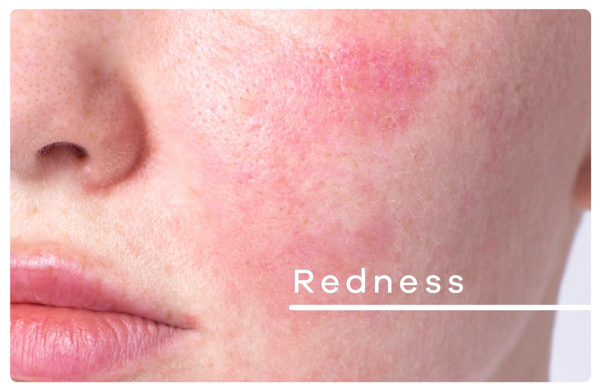 IPL: Intense Pulsed Light therapy at Anue