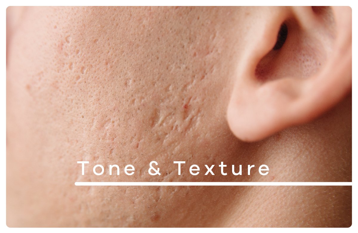 IPL: Intense Pulsed Light therapy at Anue