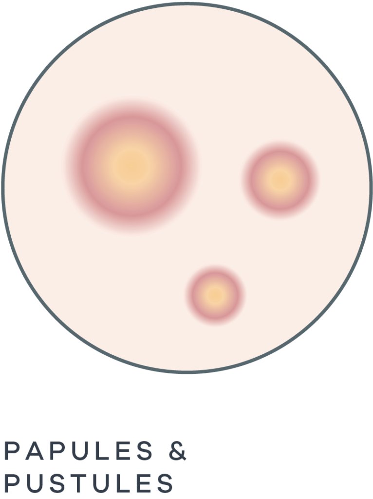 Acne: The Definitive Guide and Treatment - Anue Acne: The Definitive Guide and Treatment - Anue
