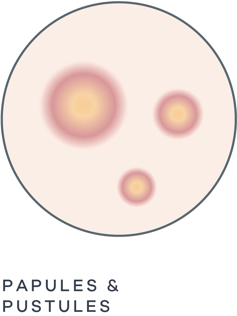 Acne: The Definitive Guide and Treatment - Anue