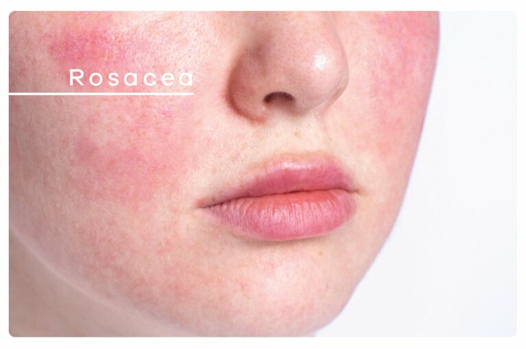 Rosacea Treatment with Anue Experts