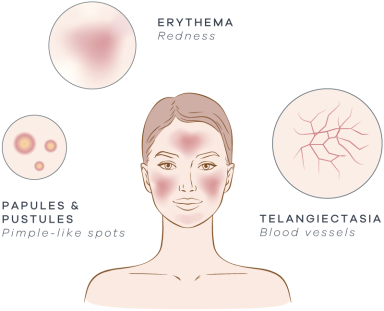 Rosacea: The Definitive Guide and Treatments - Anue