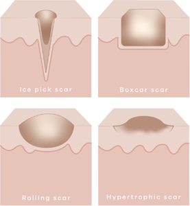Acne Scar Treatment with Anue